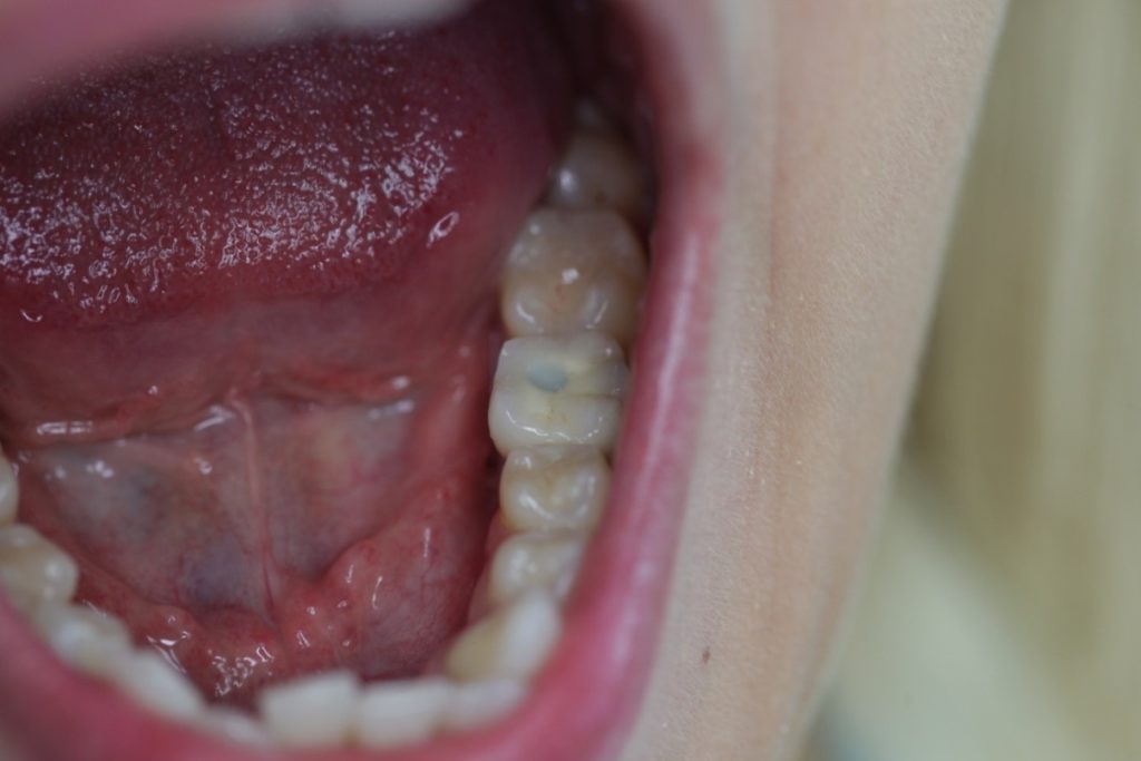 Screw-retained implant crown (case study)