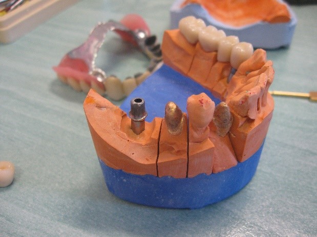 Combined prosthesis (metal ceramic bridge with removable denture) in ...