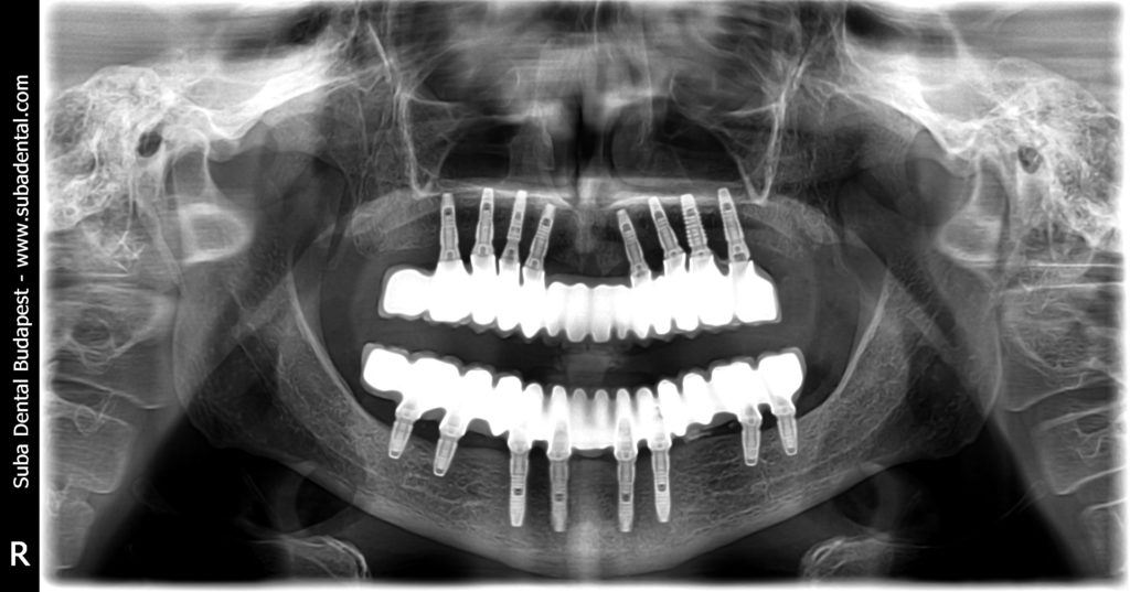 Lower and upper cement-retained full-arch metal-ceramic bridges ...
