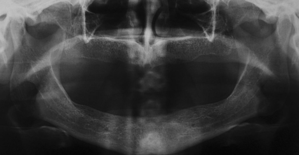 Lower and upper cement-retained full-arch metal-ceramic bridges ...