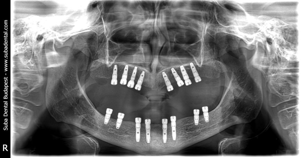 Lower and upper cement-retained full-arch metal-ceramic bridges ...