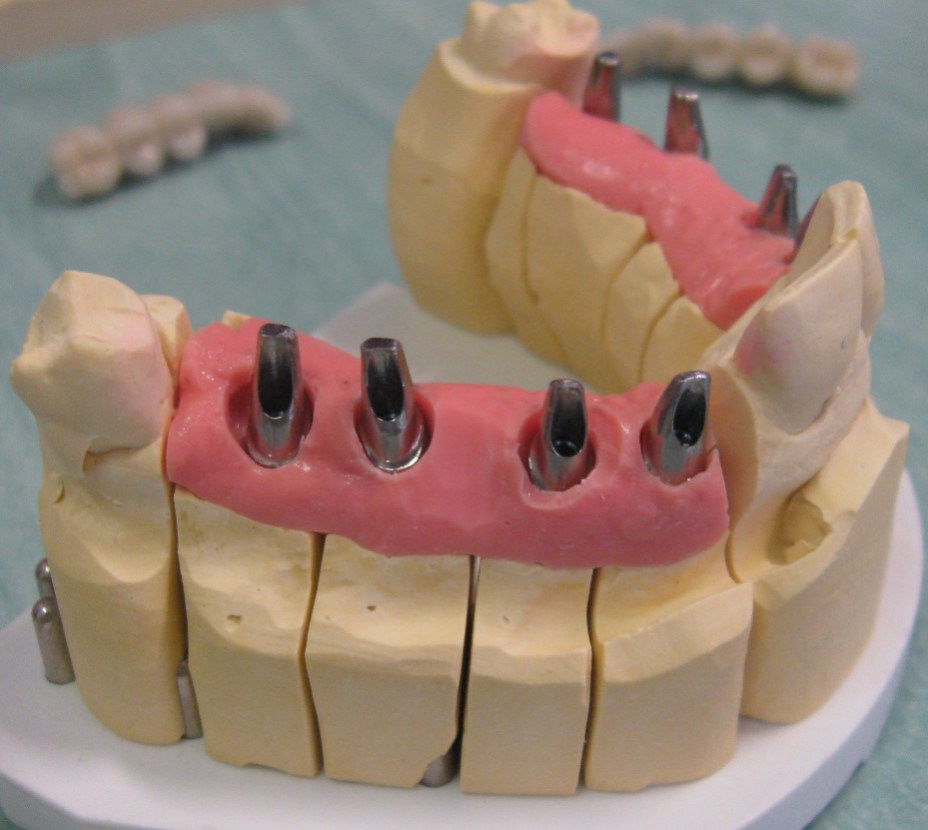 Cement-retained implant crowns (case study)