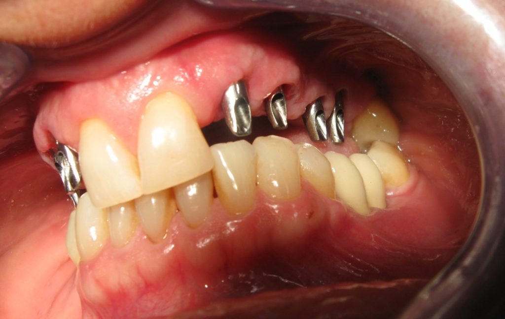 Cement-retained implant crowns (case study)