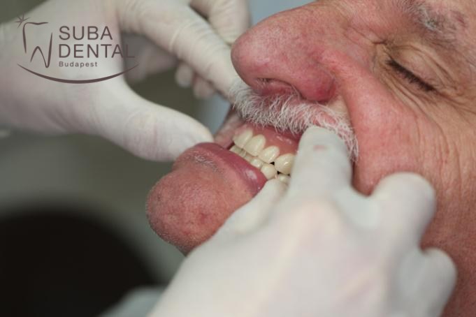 Relining an immediate denture (34)