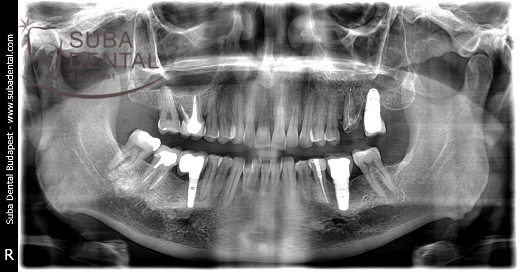 Tooth extraction, bone graft (sinus lift), implant surgery, screw ...