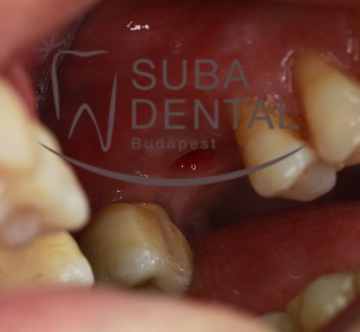 Tooth extraction, bone graft (sinus lift), implant surgery, screw ...