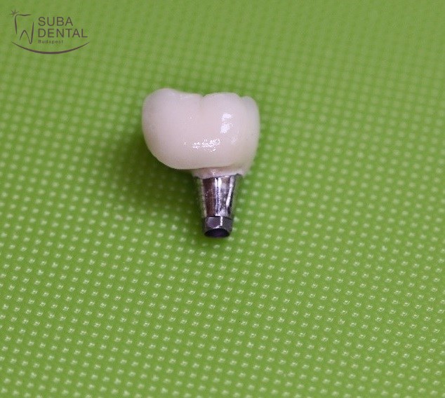 Periodontitis-related anterior edentulism restored with a metal-ceramic ...