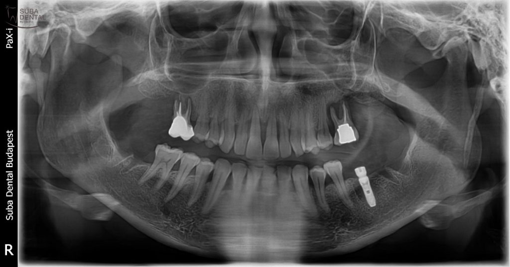 Periodontitis-related anterior edentulism restored with a metal-ceramic ...